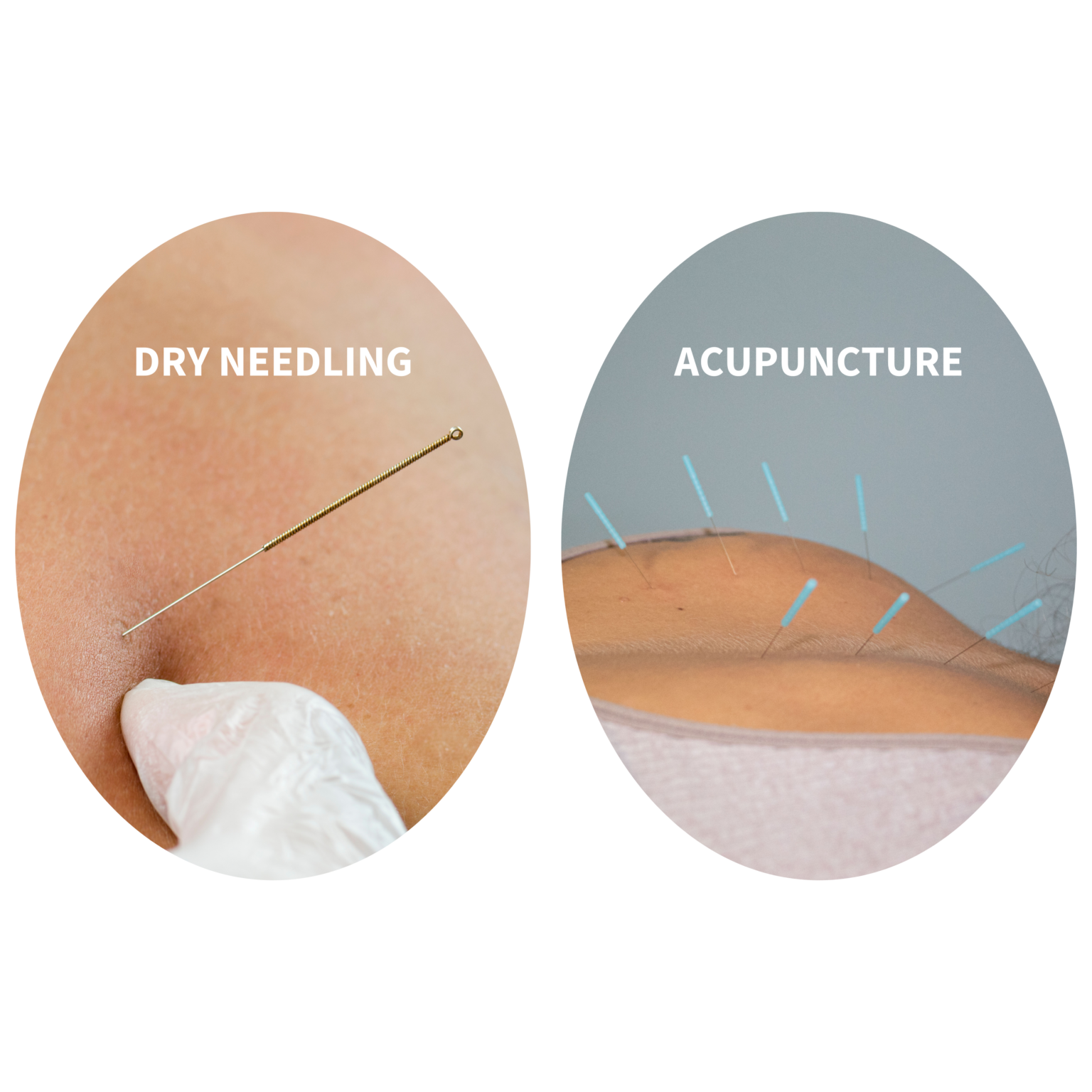 Dry needling in Midland, MI