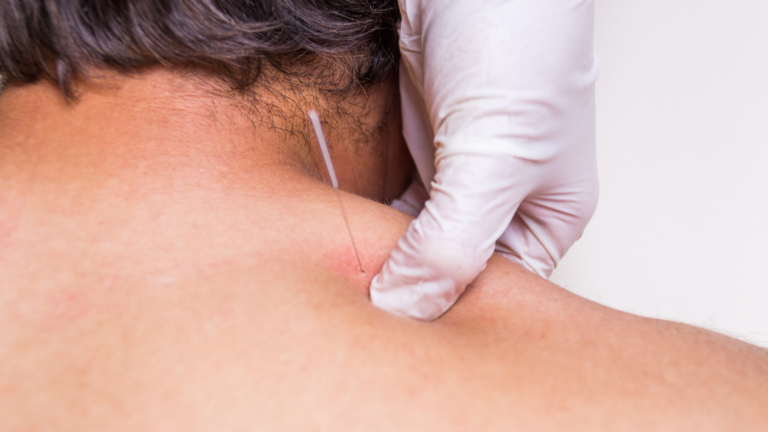 Understanding Dry Needling: Trigger Points Physical Therapy Treatment ...